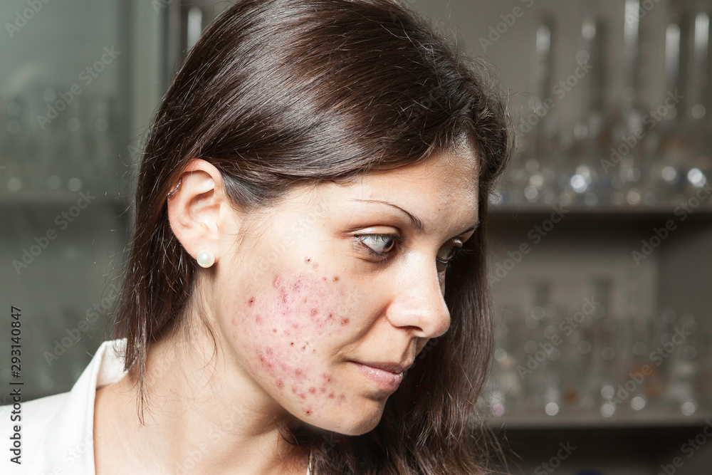 A professional and successful scientist woman is seen with bad acne and ...