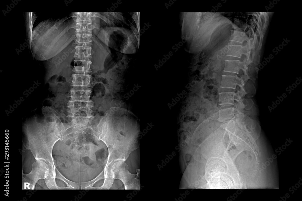 Two X-ray images of lumbar spine .Lumbar Degenerative Spinal Canal ...