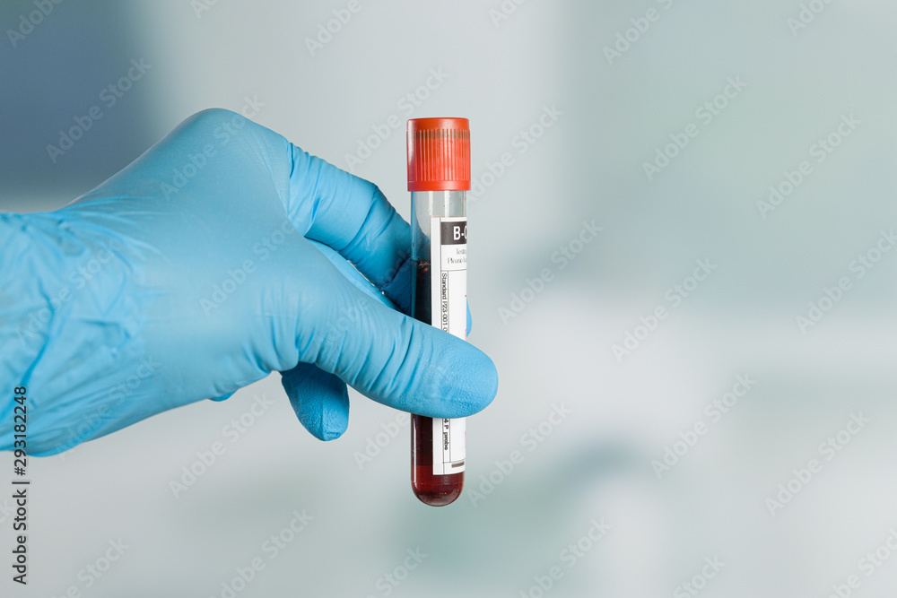 Doctor's hand with medical glove holding a blood probe. in front of a ...