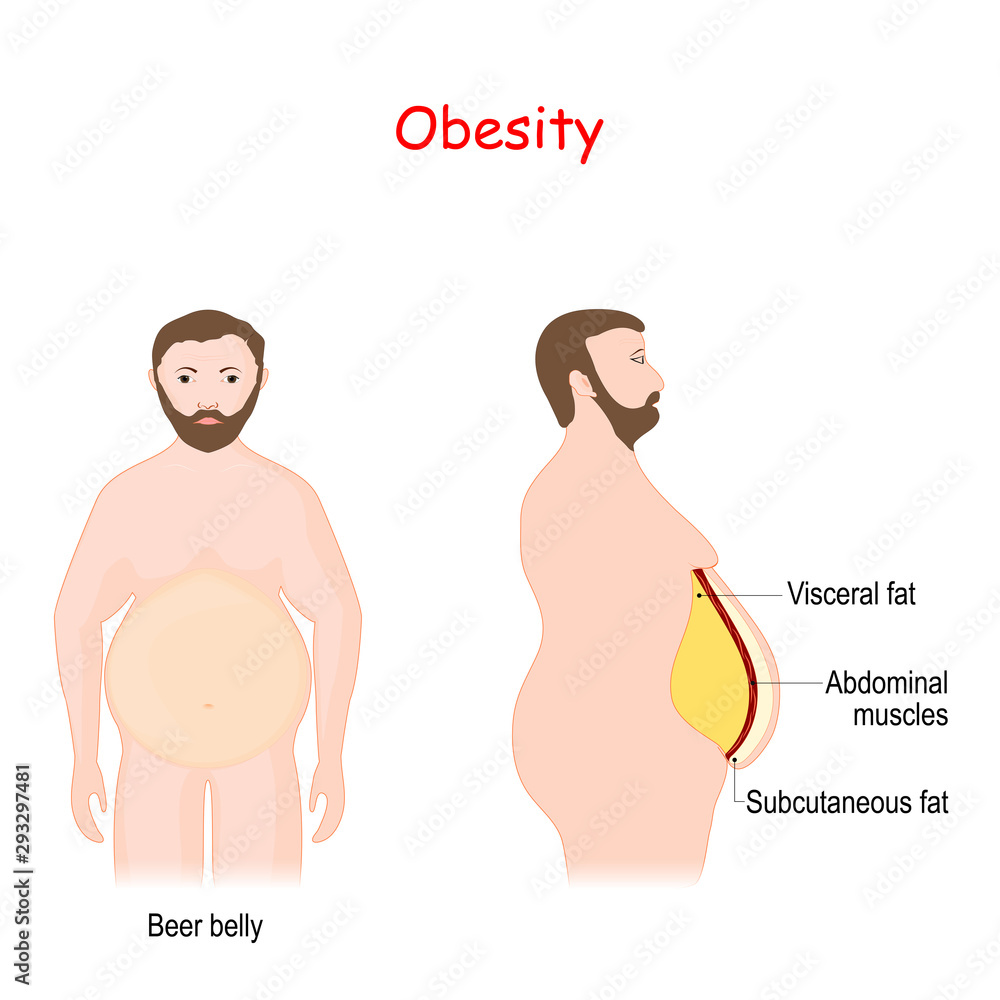 Poster Abdominal obesity. Visceral and subcutaneous fat. – Wall Art ...