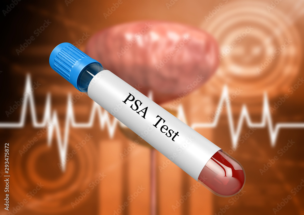 Blood sample in laboratory test tube for PSA examination for detection ...
