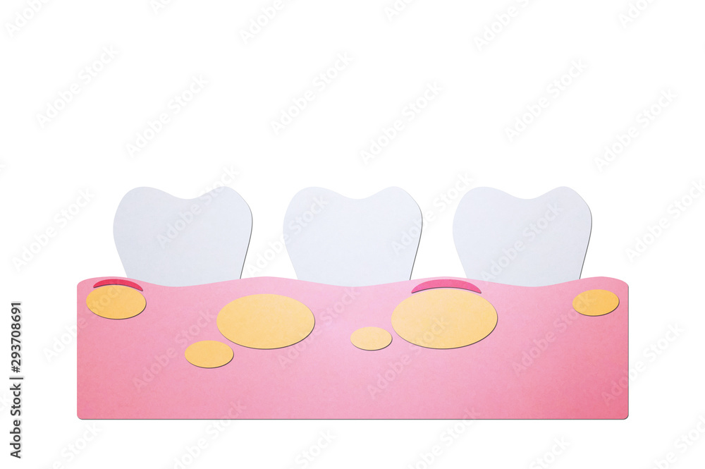 unhealthy teeth because gingivitis with abscess in gum and dental ...