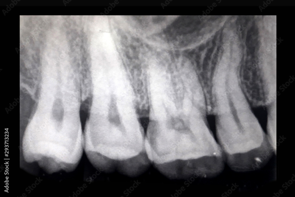 X-ray of teeth, Closeup of Teeth x-ray showing problem with infected ...