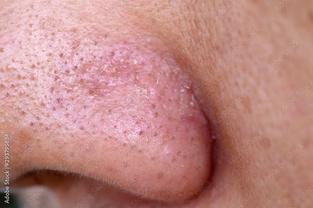 close-up blackheads on the nose Stock Photo | Adobe Stock