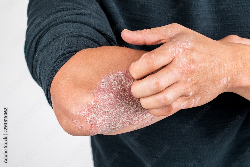 Man with sick hands, dry flaky skin on his hand with vulgar psoriasis ...