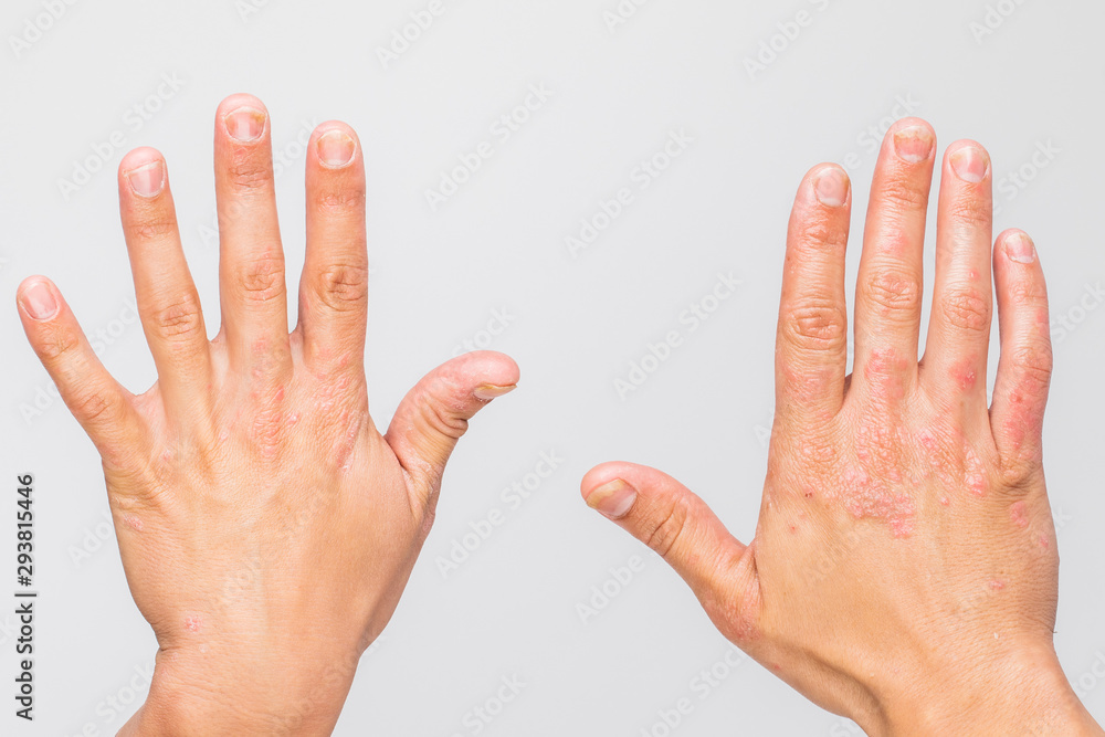 Man with sick hands, dry flaky skin on his hand with vulgar psoriasis ...