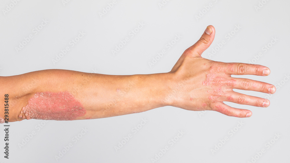 Man with sick hands, dry flaky skin on his hand with vulgar psoriasis ...