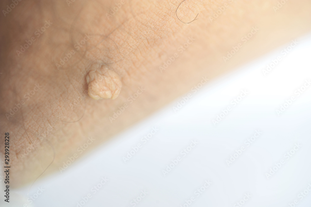 Pedunculated Mass skin tag or acrochondon or soft fibroma. Papilloma ...