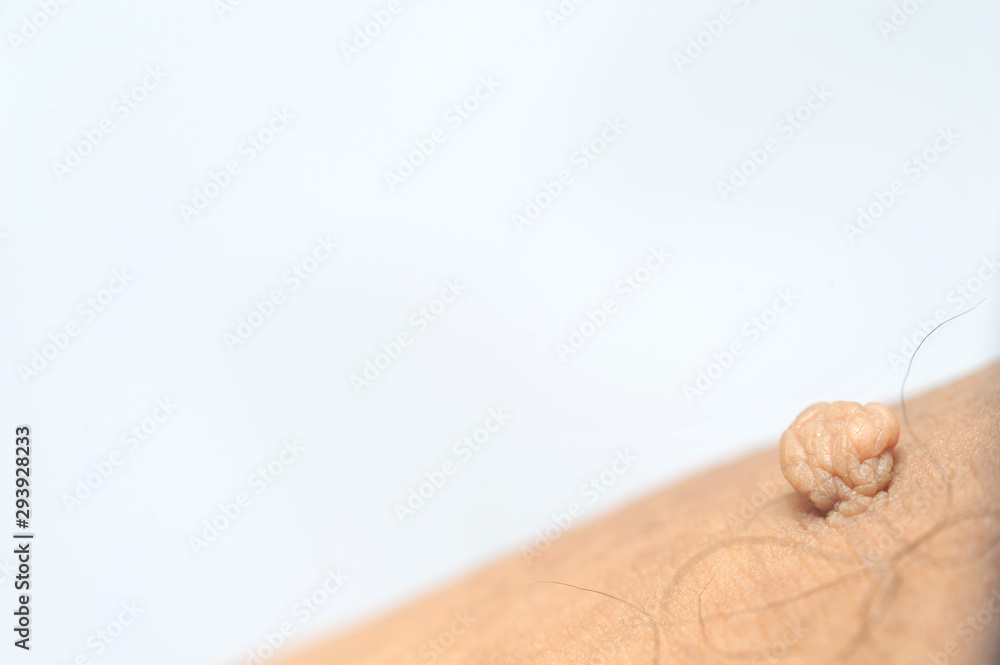 Pedunculated Mass skin tag or acrochondon or soft fibroma. Papilloma ...