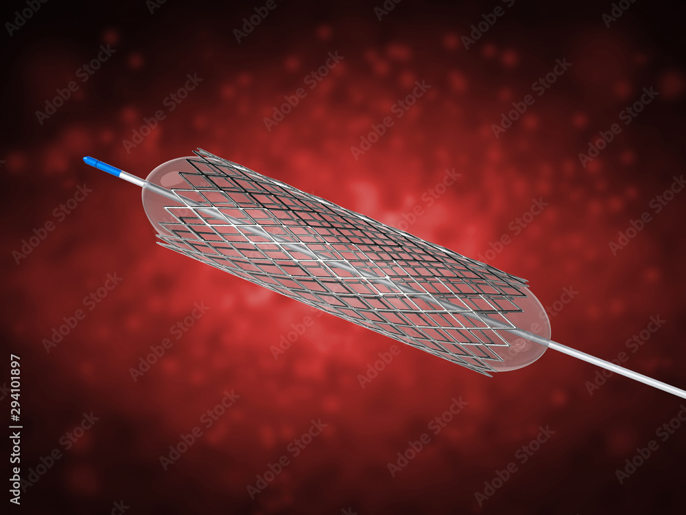 Stent for balloon angioplasty Stock Illustration | Adobe Stock