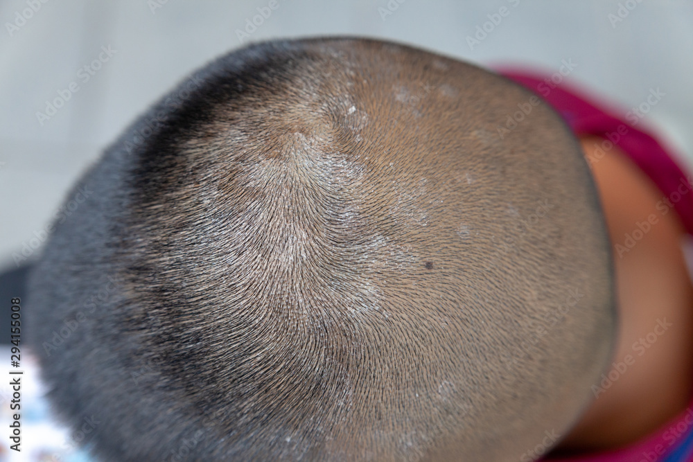 Close-up skin head , scalp, photos of dermatitis and eczema, skin ...