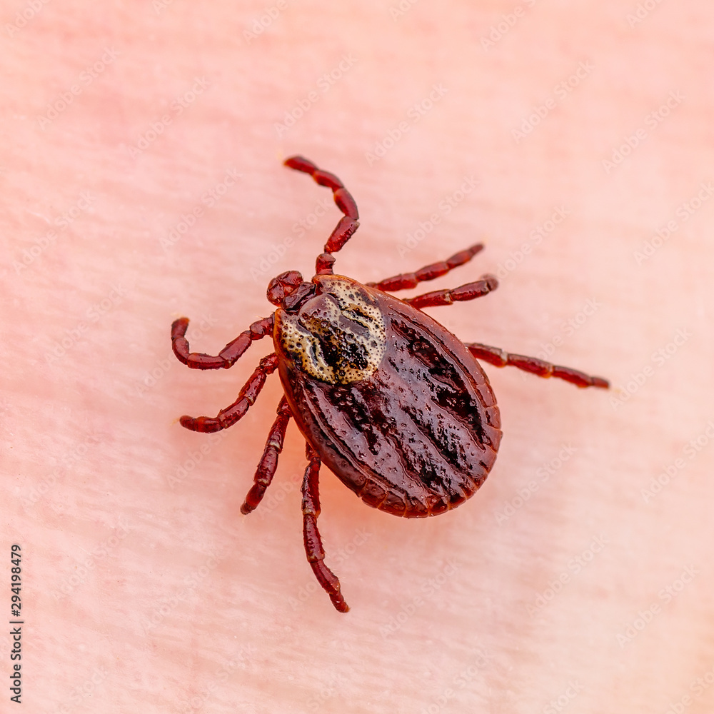 Encephalitis Tick Insect Crawling on Skin. Encephalitis Virus or Lyme ...