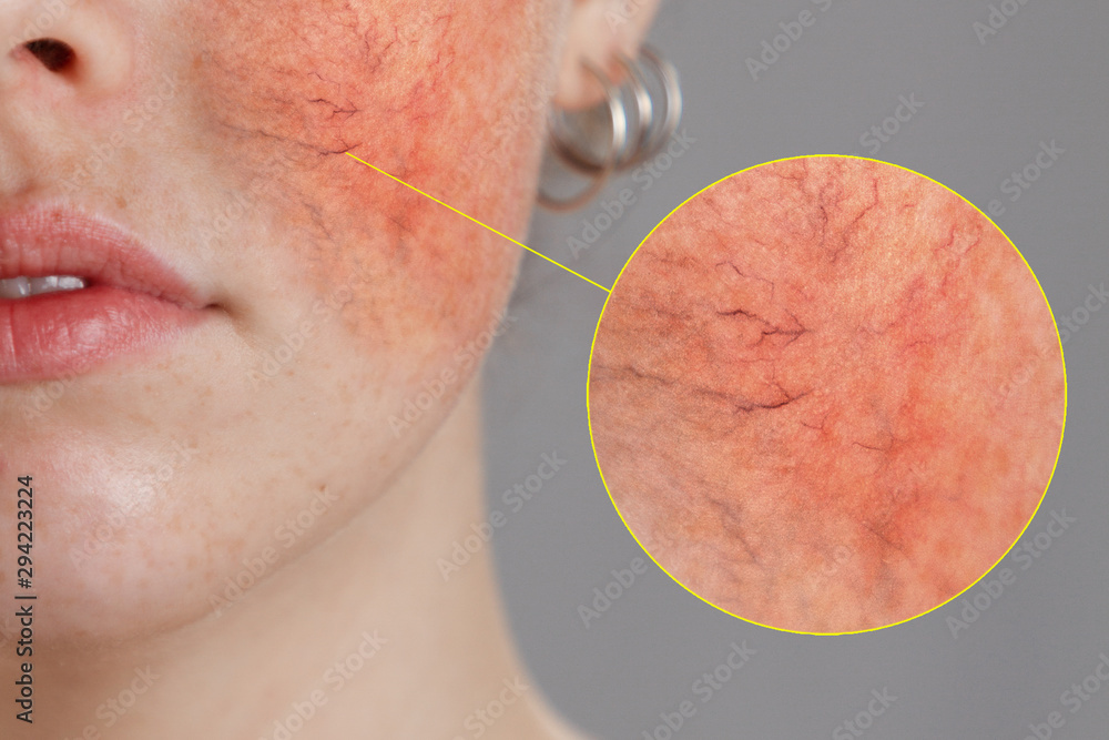 Rosacea On Cheeks