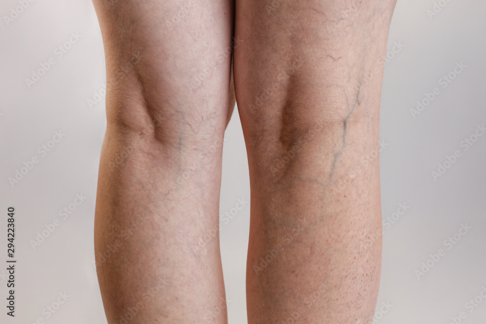 Varicose veins and medicine. Female legs close - up with vessels and ...