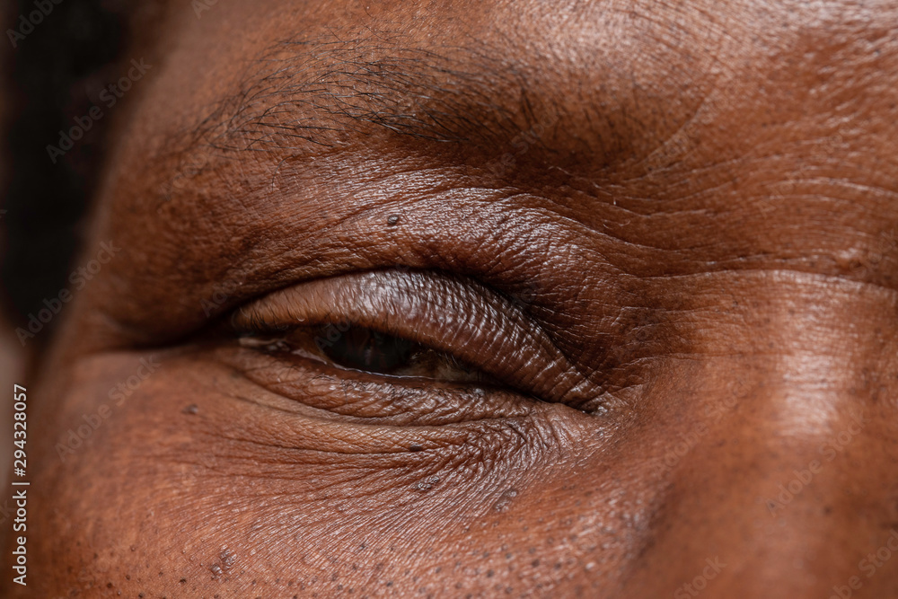 Woman with drooping eyelid, symptoms of congenital palpebular ptosis ...
