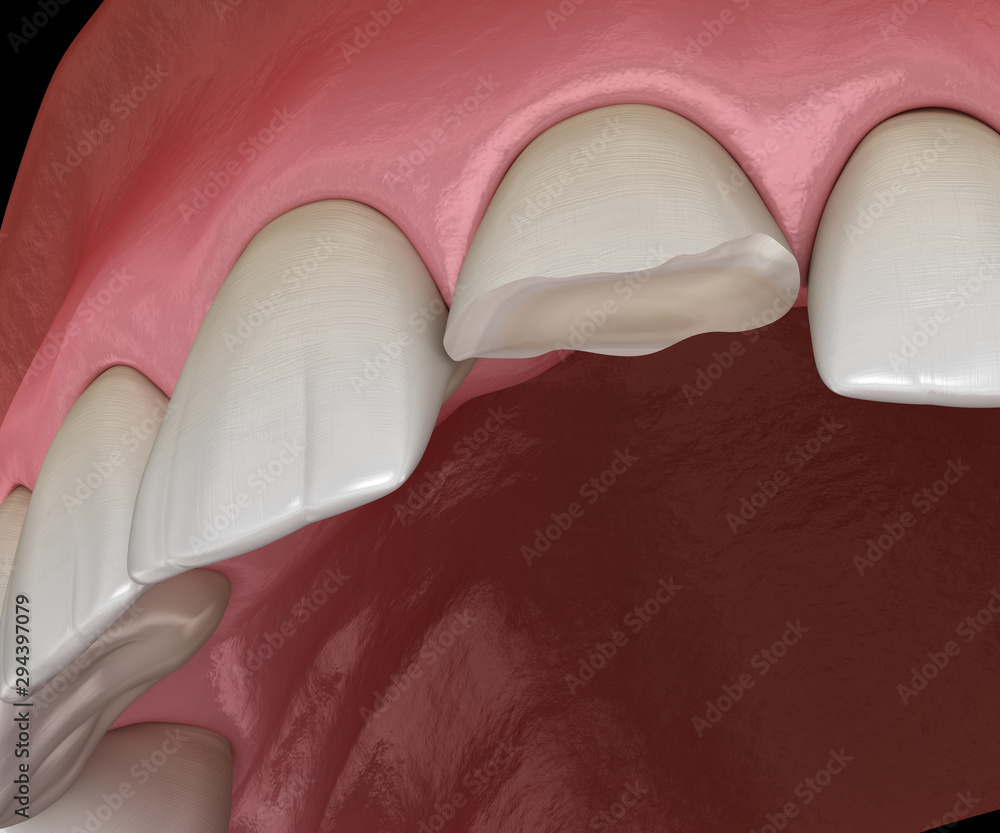 Broken central incisor tooth. Medically accurate 3D illustration of ...