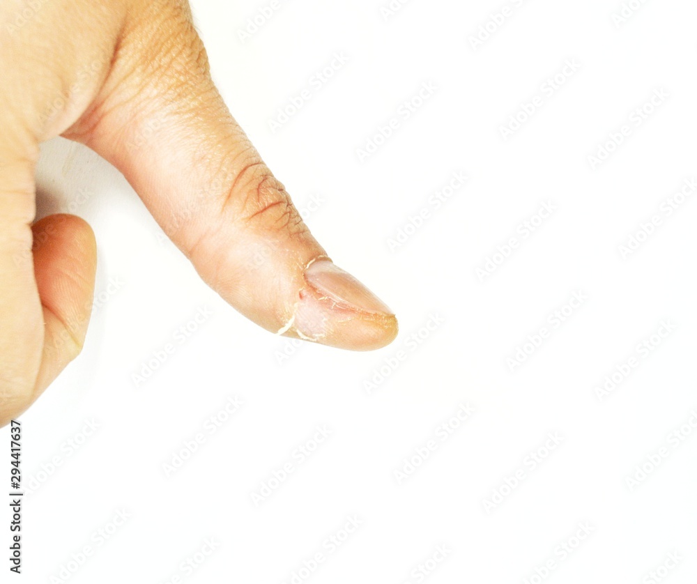 Excoriation (skin-picking) Disorder.Picking The Skin Around Nails and ...