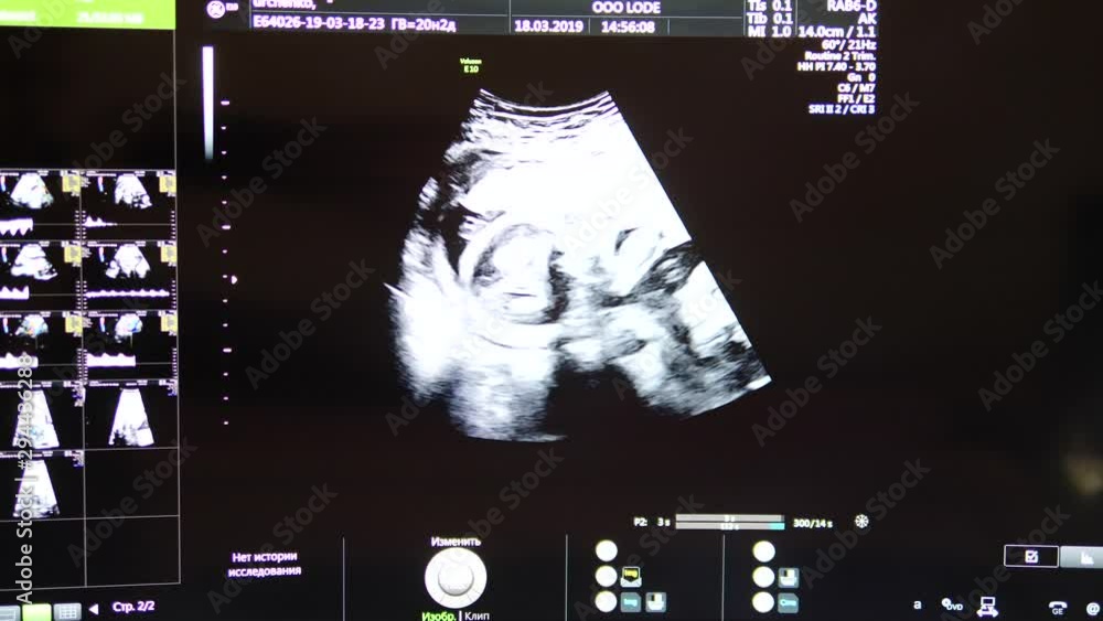 2D Ultrasound Display Of 22 Weeks Pregnant. Fetus Ultrasound Image That ...