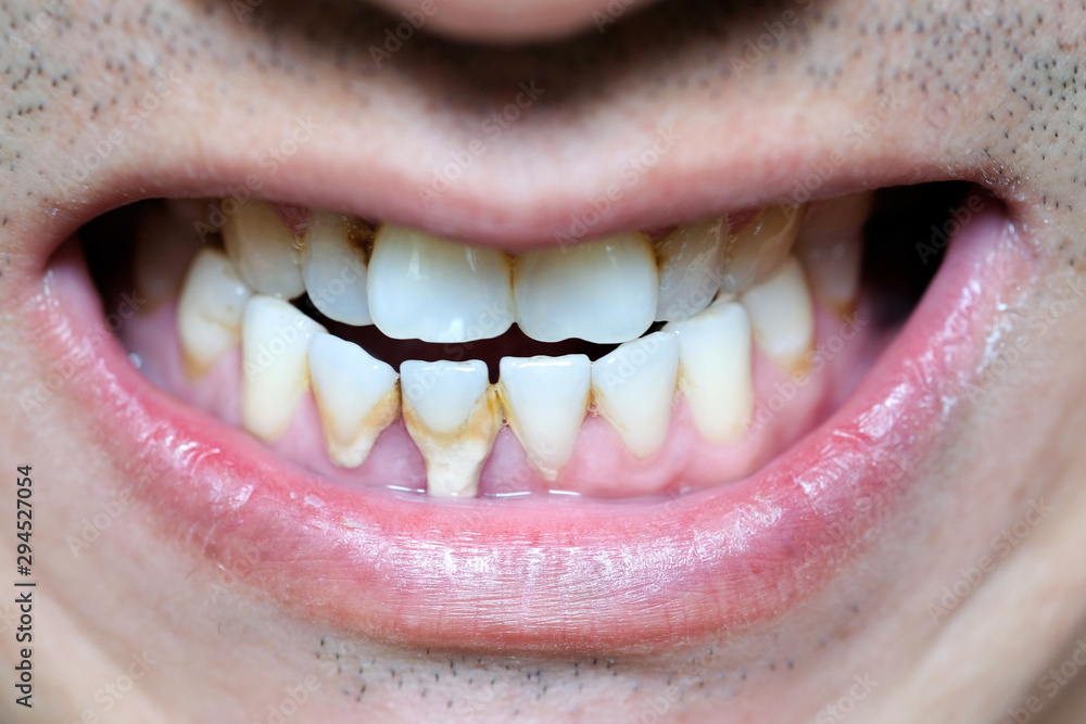 Tooth's a man smoking bad. Man smokes a cigarettes have tooth decay and ...