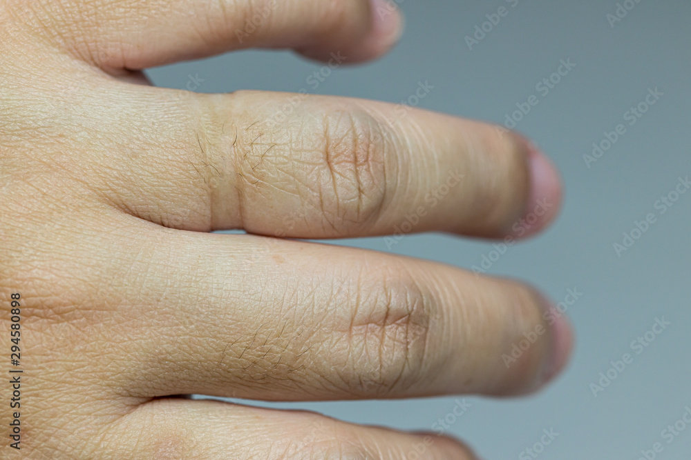 Ring wound in the right hand on the finger. Part of a human hand where ...