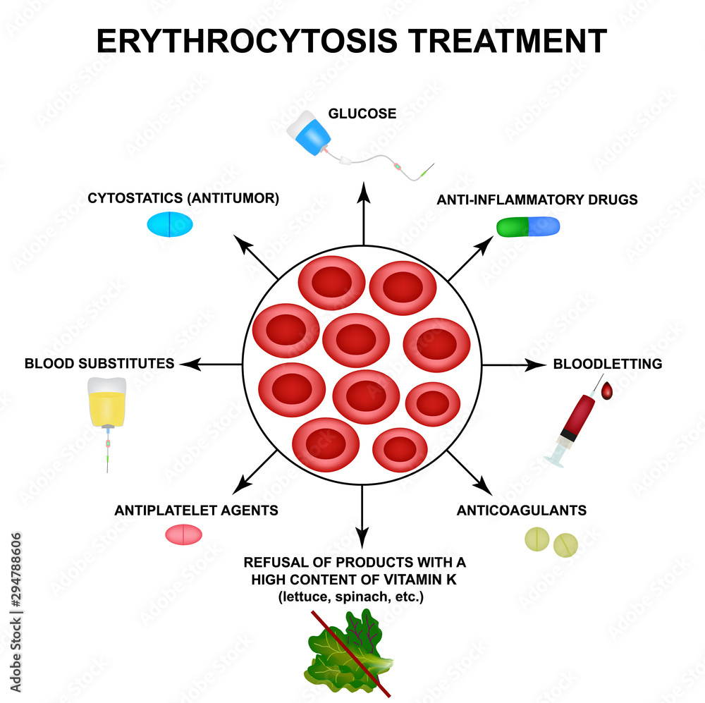 Erythrocytosis treatment. Increased red blood cells. Cells erythrocytes ...