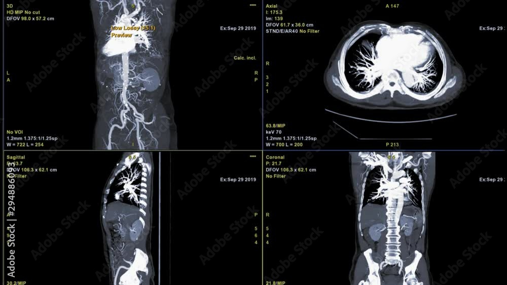 CTA Whole aorta 3D rendering image comparison with axial, Coronal and ...