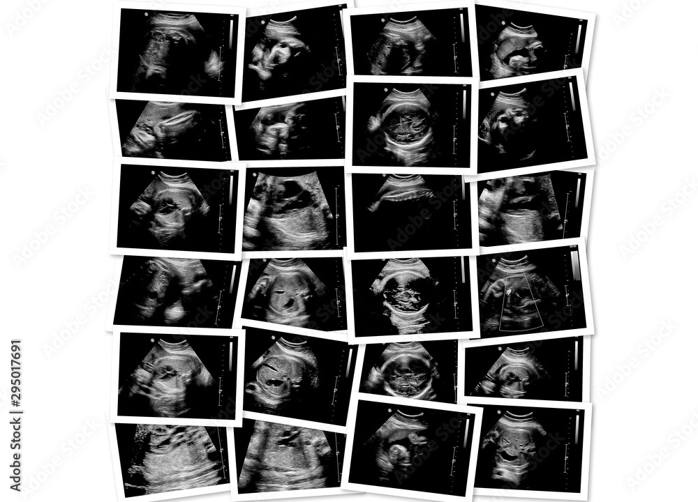 Collection of images showing 15 weeks pregnant ultrasound of baby or ...