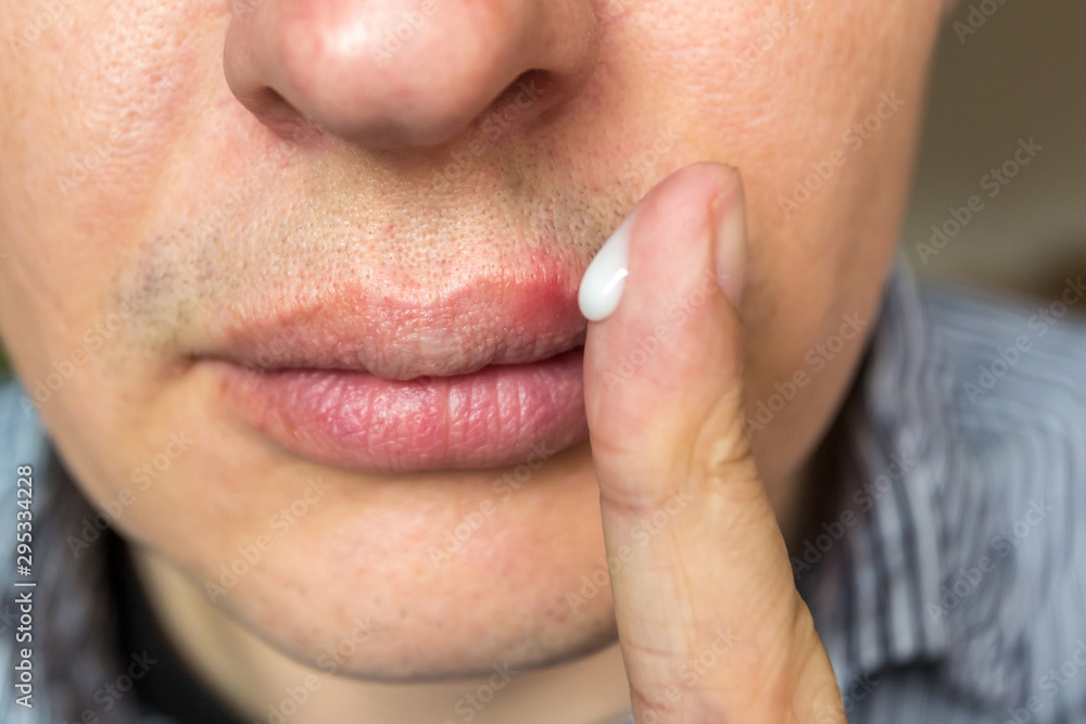 red inflammation and herpes zoster virus on upper male lip Stock Photo ...