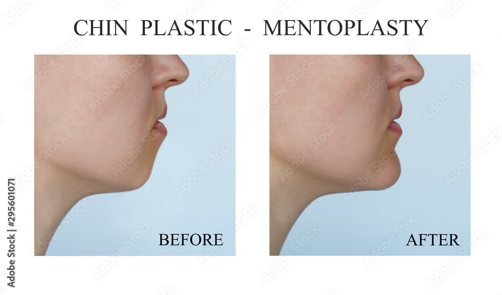Chin Plastic before and after procedures. Mentoplasty Stock Photo ...
