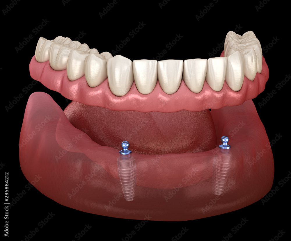 Mandibular removable prosthesis All on 2 system supported by implants ...