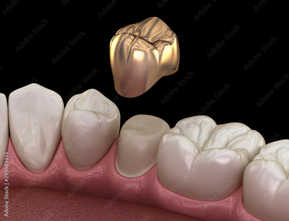 Golden crown premolar tooth assembly process. Medically accurate 3D ...
