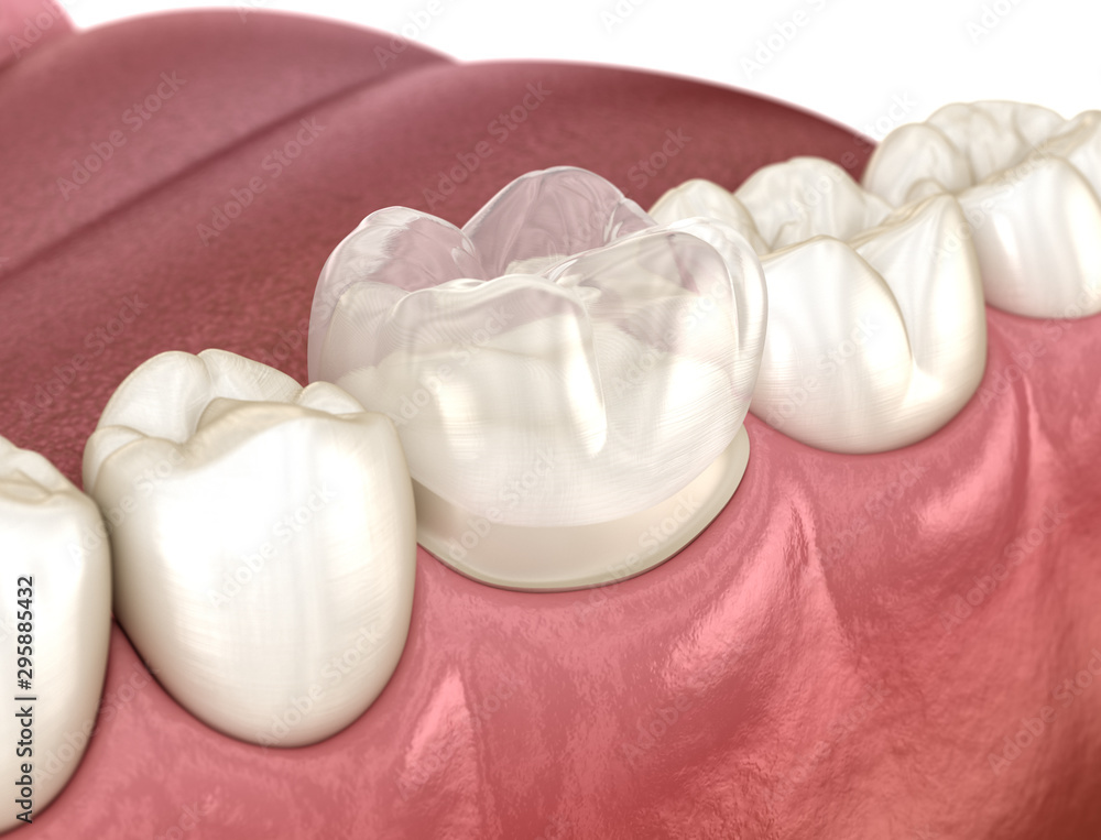 Preparated molar tooth for dental crown placement. Medically accurate ...