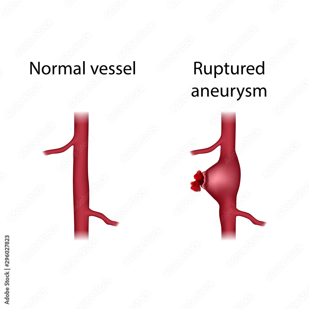 Normal vessel and ruptured aneurysm. Medical anatomy illustration ...