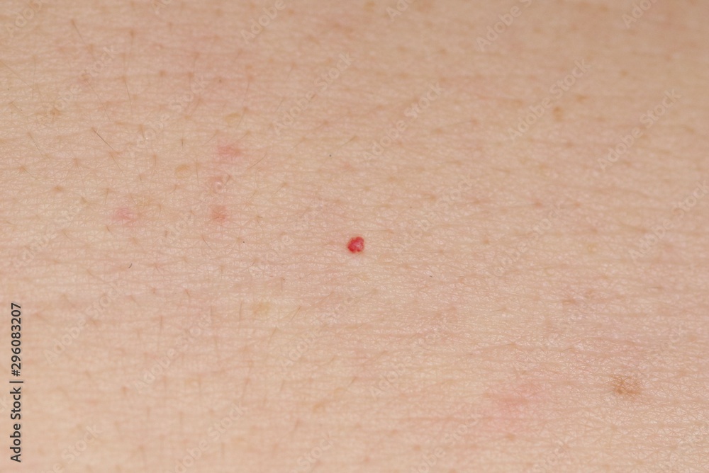 Cherry Angioma or Campbell de Morgan spots Stock Photo | Adobe Stock