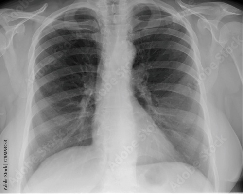 normal radiography of chest organs in direct projection, pulmonology ...