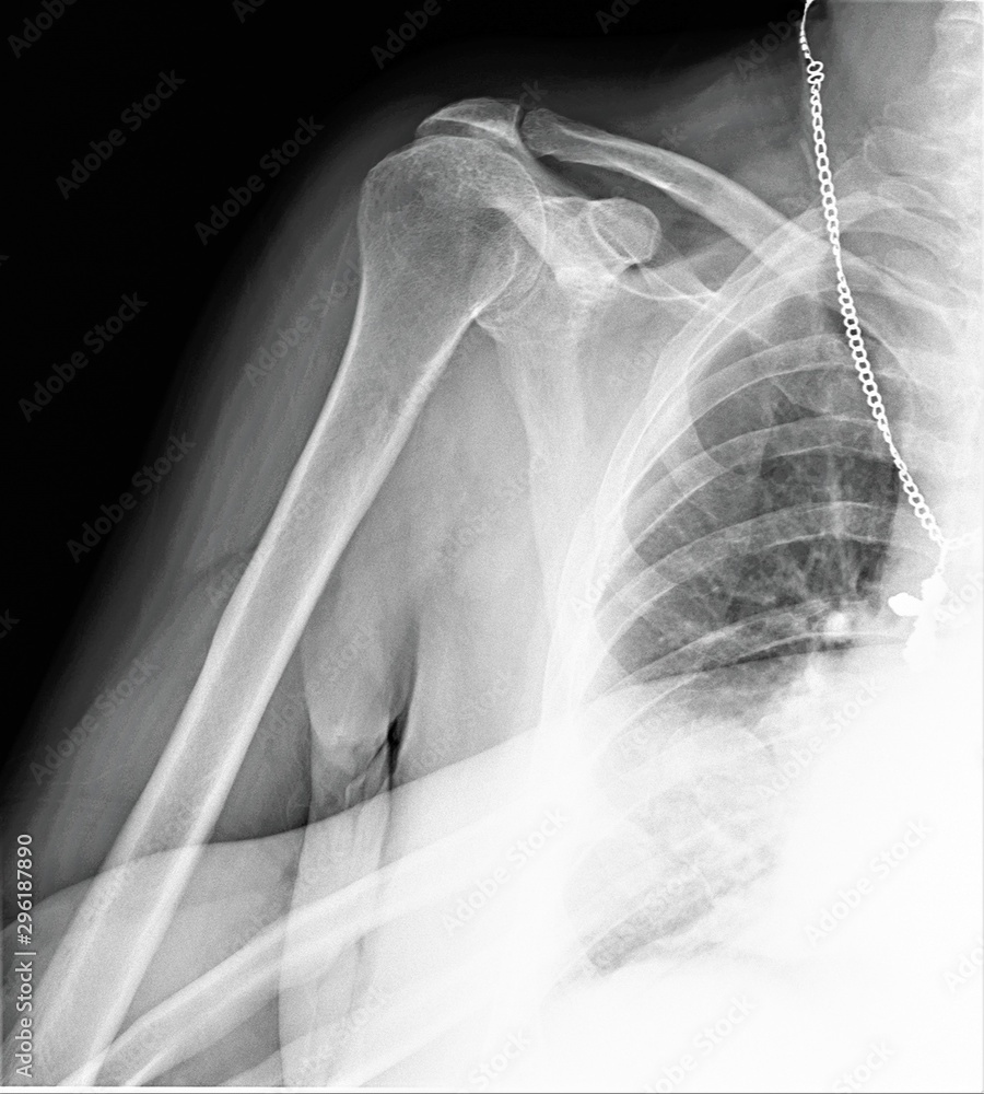 normal x-ray of the shoulder joint Stock Photo | Adobe Stock