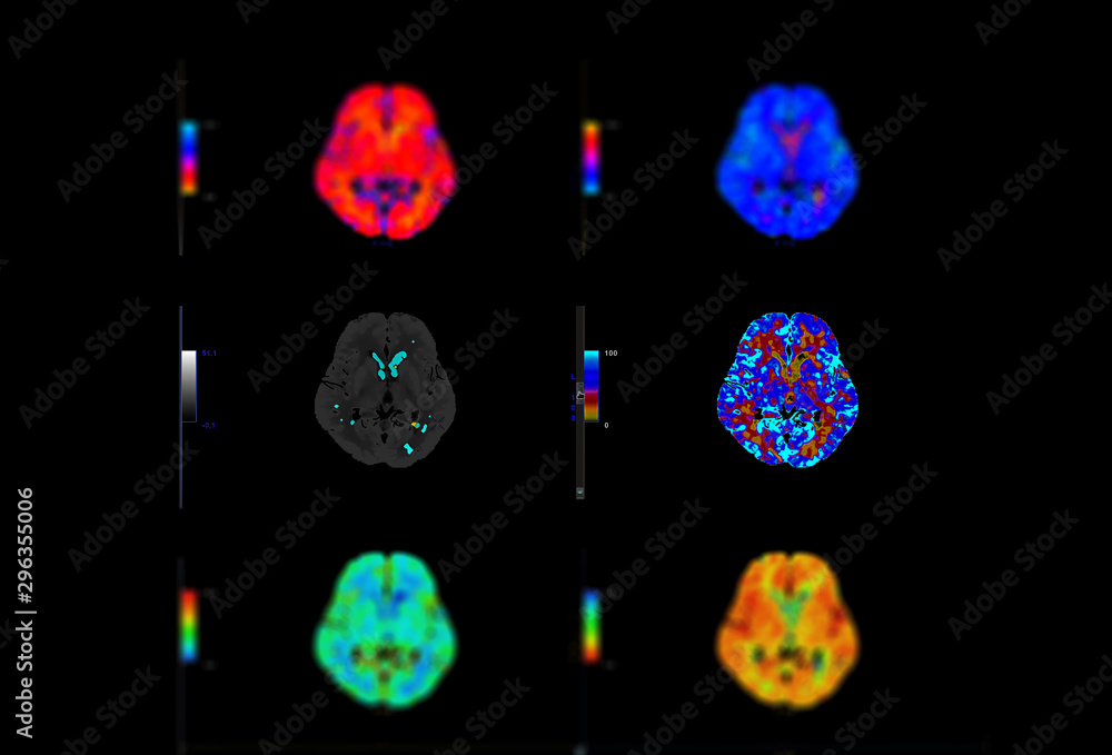 Selective Focus Of Ct Brain Perfusion Or Ct Scan Image Of The Brain 3d Rendering Image Analyzing