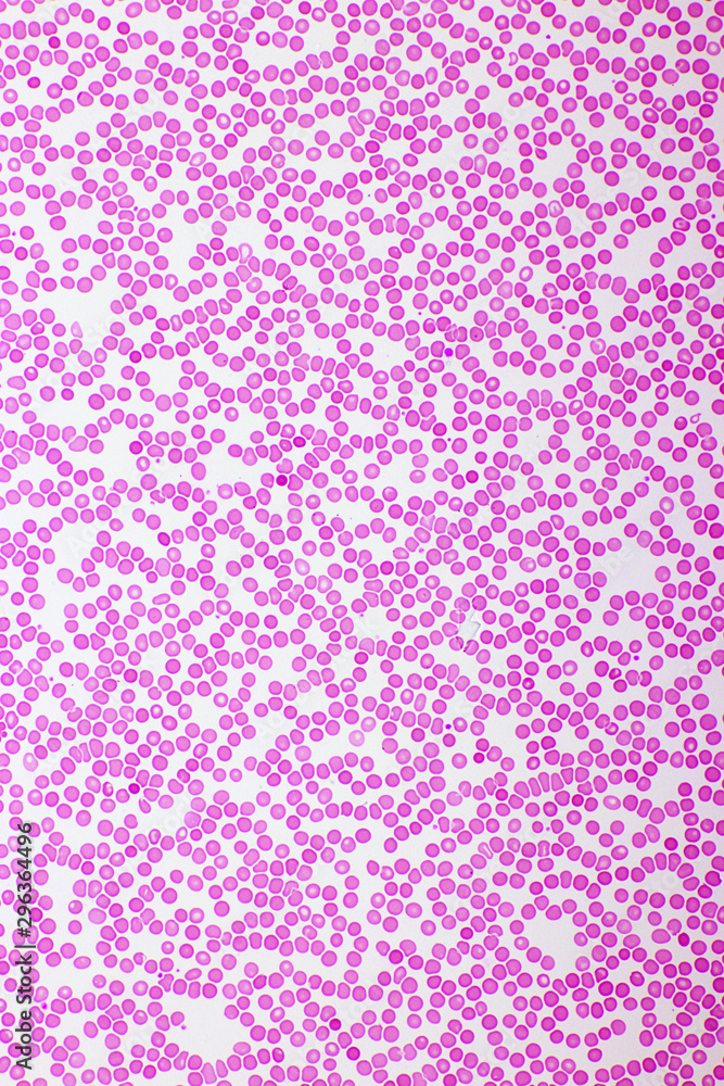 Red blood cells in blood smear, Wright-Giemsa stain, analyze by ...