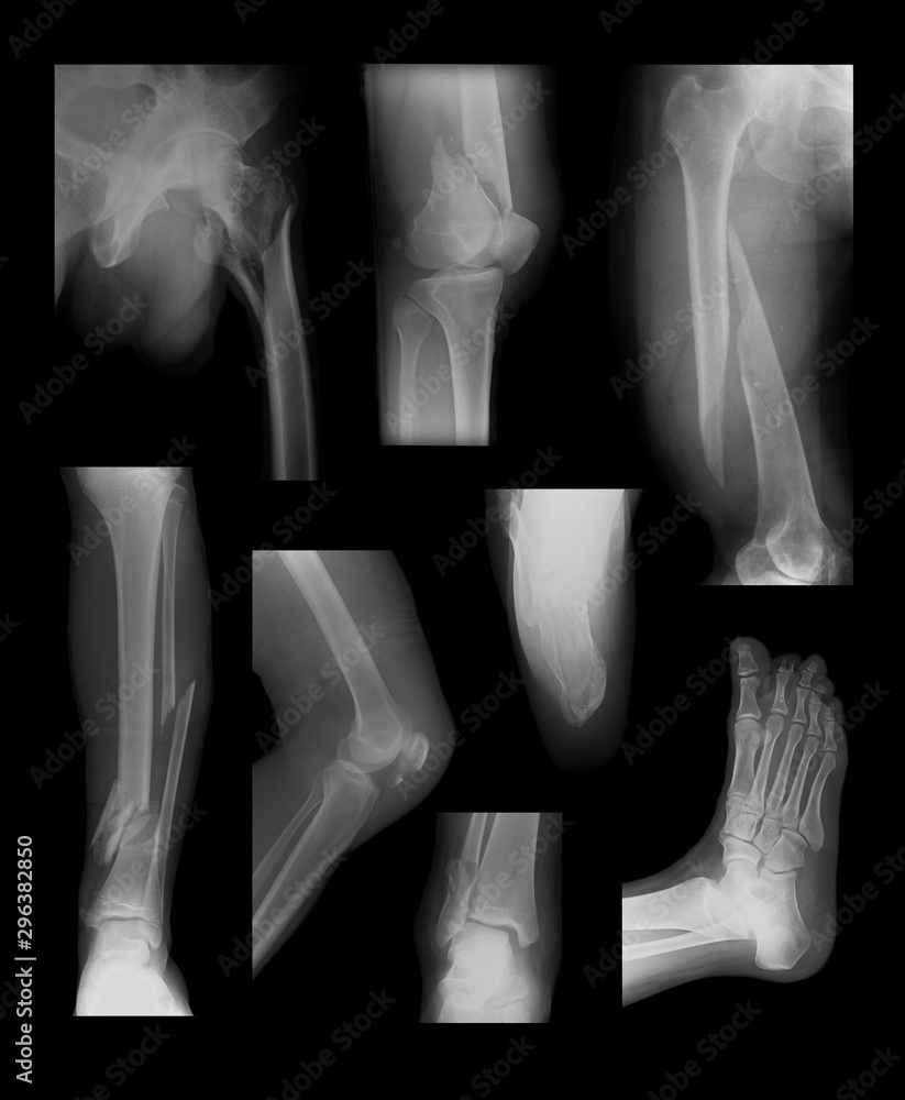 X-ray image showing lower extremity fractures Stock Photo | Adobe Stock