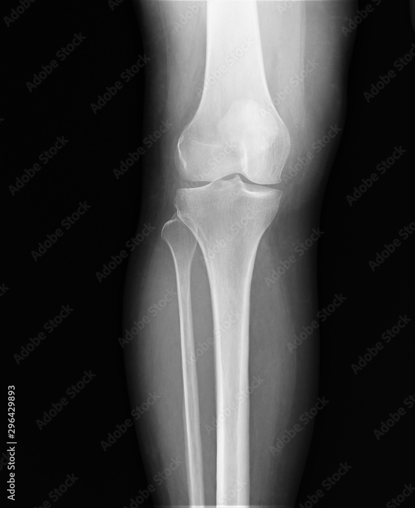 Normal Knee Joint