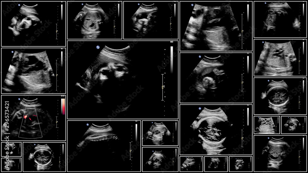 Collection of images from ultrasound scan examination Stock Photo ...