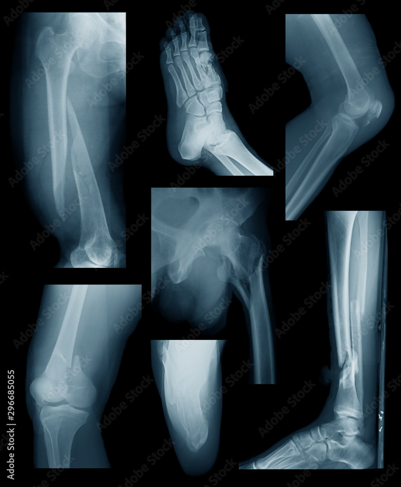 Collection X-ray image show lower limb or lower extremity fractures ...