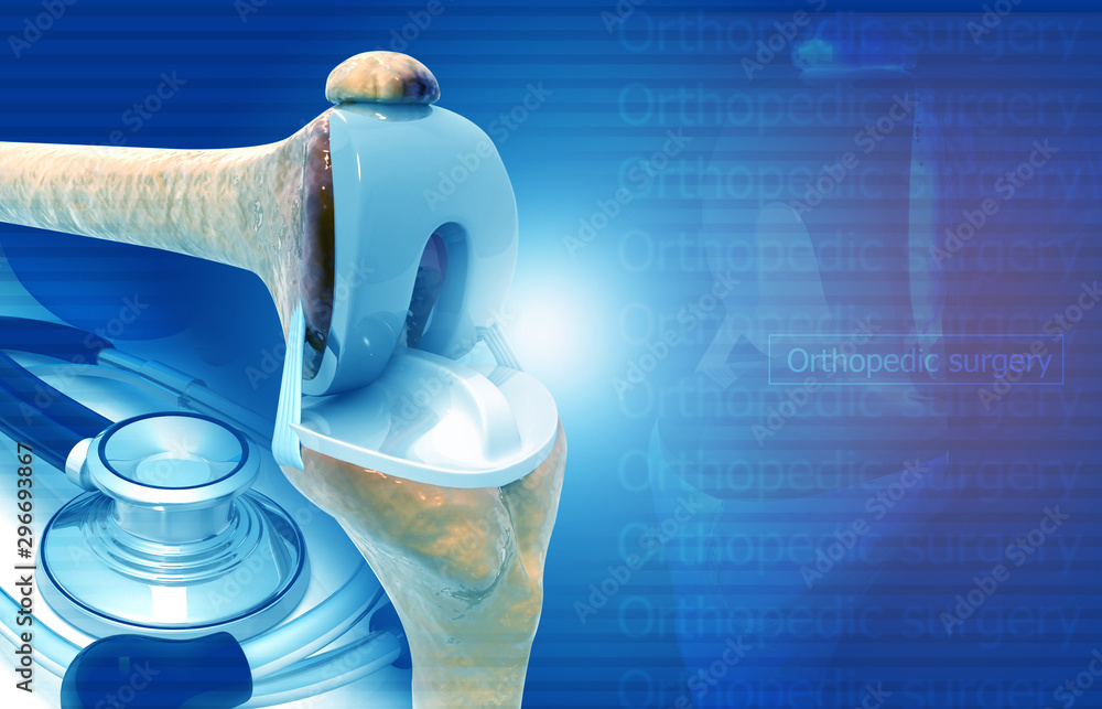 ภาพประกอบสต็อก Knee joint replacement. medical background concept. 3d ...