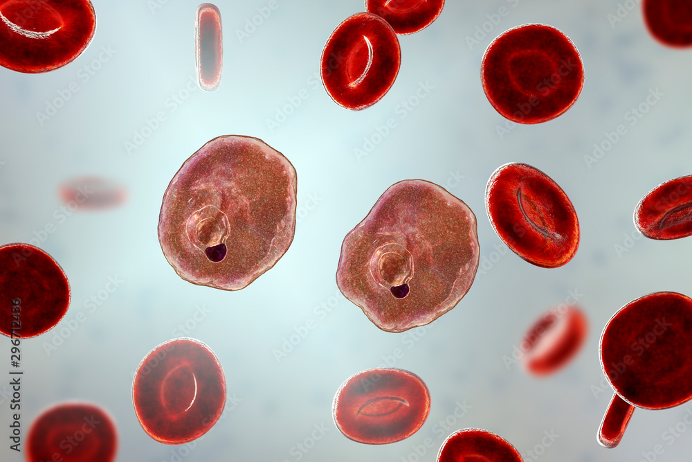 The malaria-infected red blood cells. 3D illustration showing malaria ...