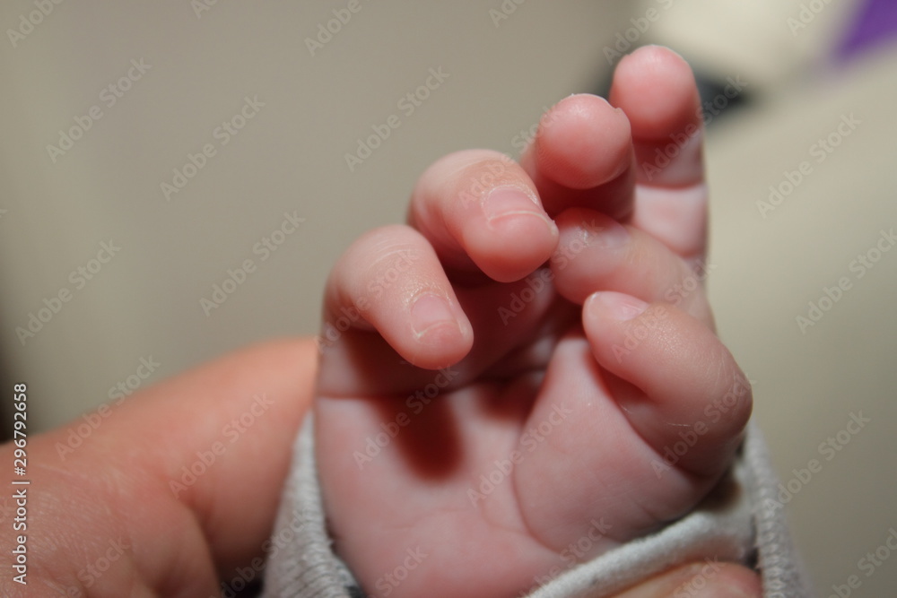 Polydactyly Preaxial, Polydactyly on human; rare abnormal ...