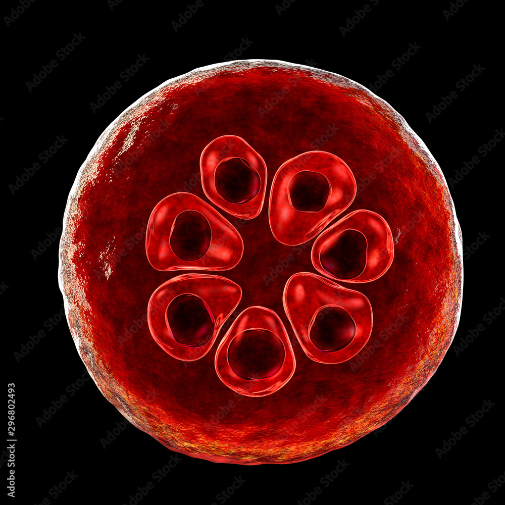 The malaria-infected red blood cell. 3D illustration showing parasite ...