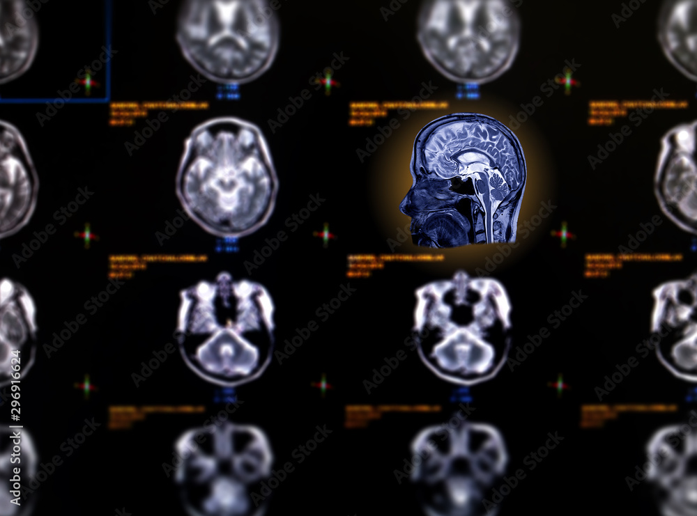 Sagittal View Of Brain Mri