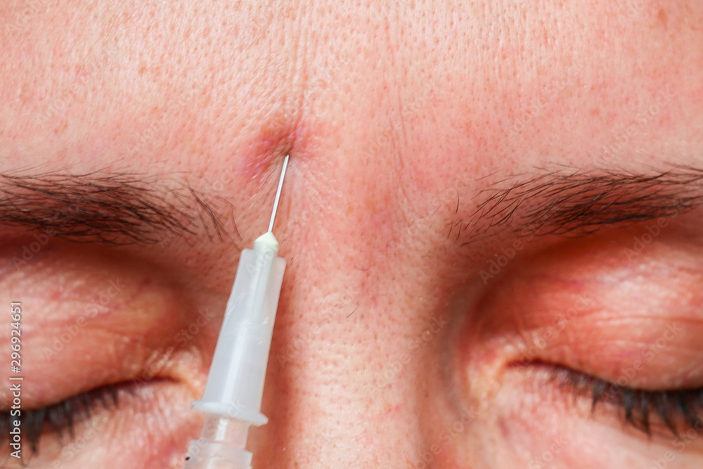 cosmetic injections under the skin of a woman's face, anti-aging ...
