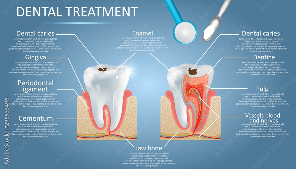 Dental treatment vector diagram education medical anatomy poster ...