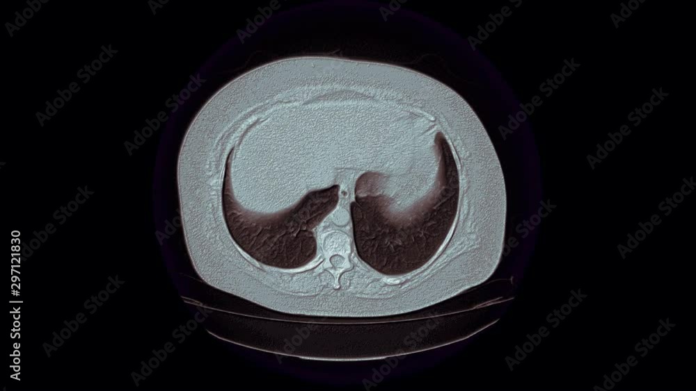 MRI scan of the lungs and bronchi, diagnosis of respiratory diseases ...